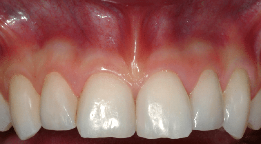 Gengive sane e denti belli: l'estetica della bocca - Studio Dentistico ...