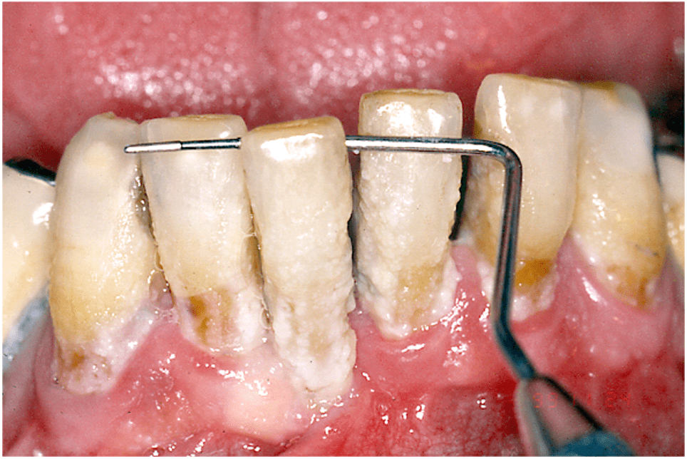 Ho la piorrea: voglio guarire - Studio Dentistico Prof. Checchi ...