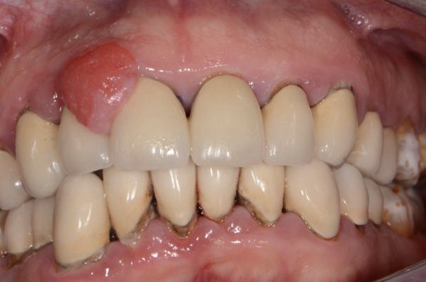 Come si risolve il problema dell’epulide? - Studio Dentistico Prof ...