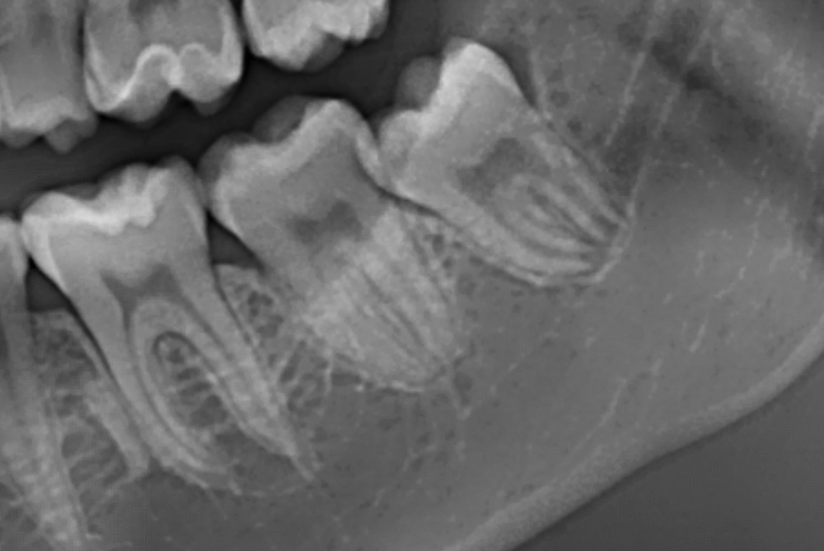 Lesioni del nervo alveolare inferiore a seguito di estrazione del dente ...